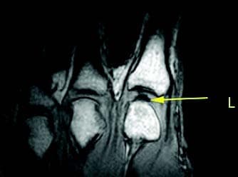 before and after cracking knuckles